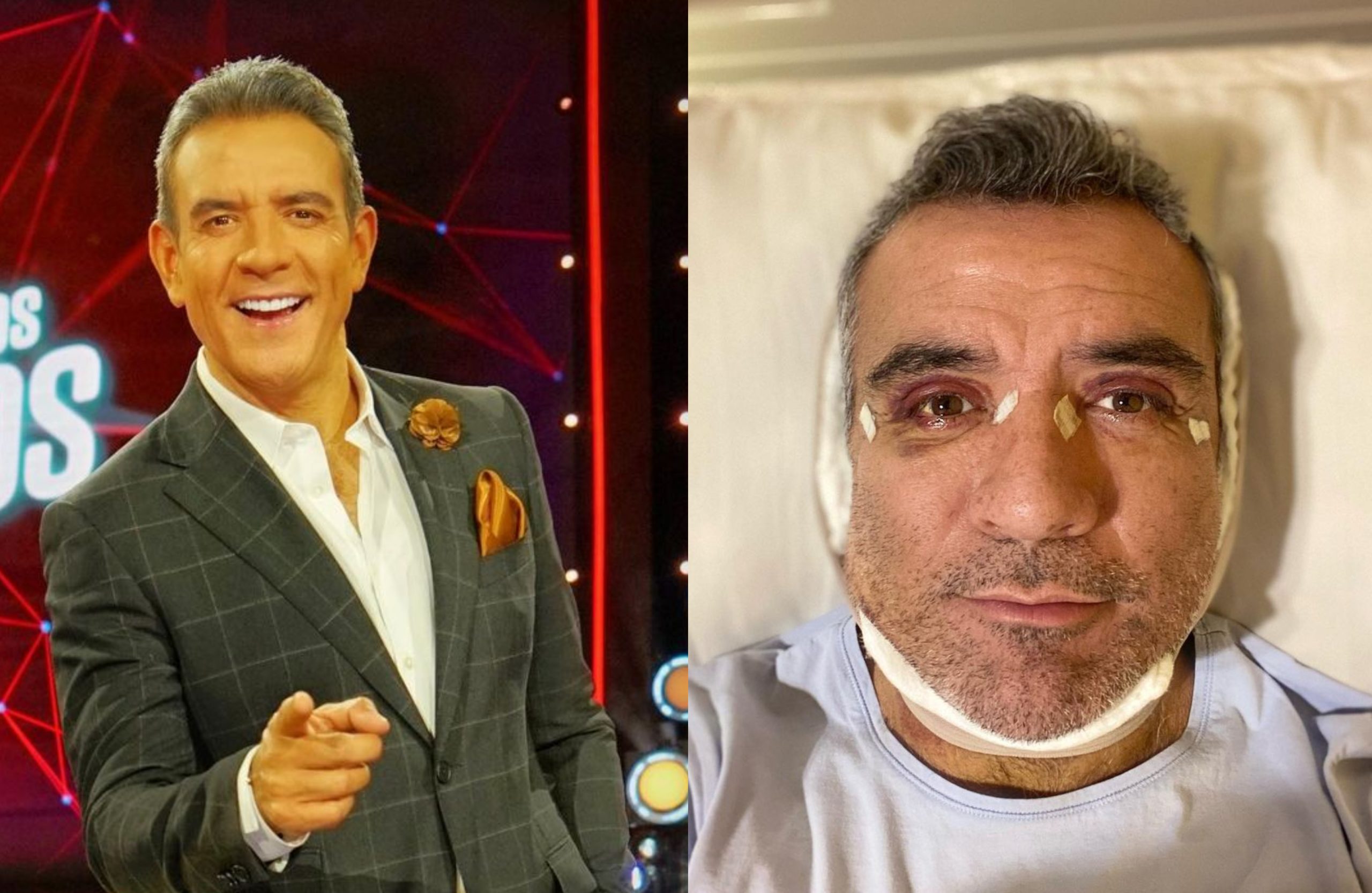 Héctor Sandarti fue hospitalizado; deja ver su rostro con vendas - Diario de Yucatán