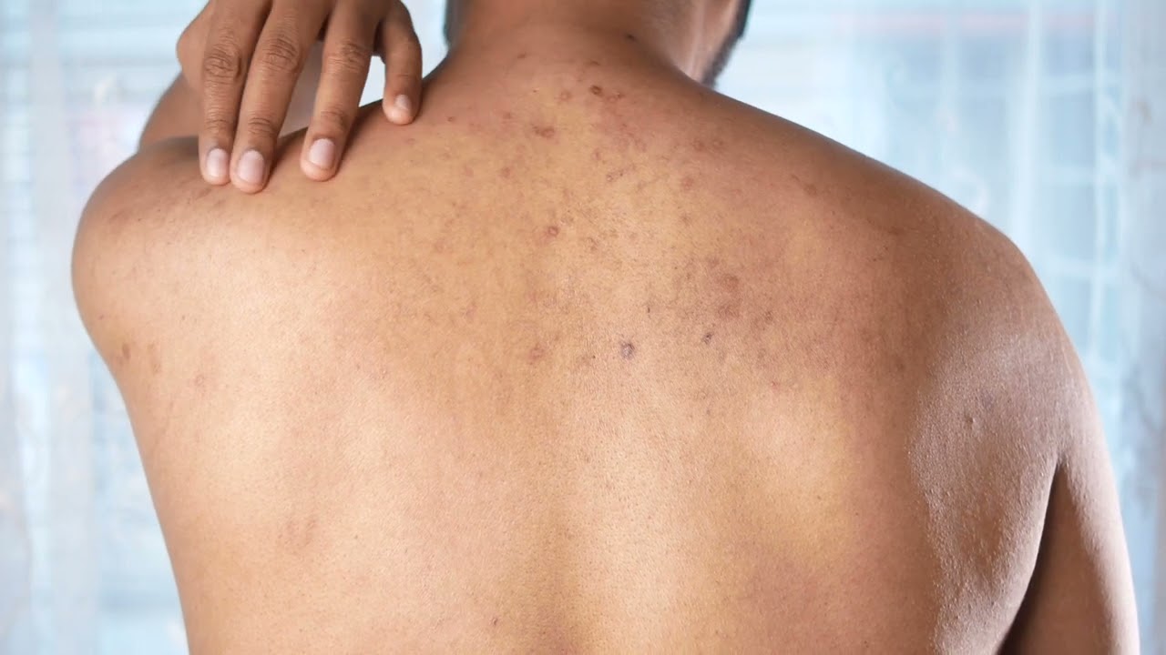 ¿Cómo saber si las manchas en la piel son malignas y peligrosas?